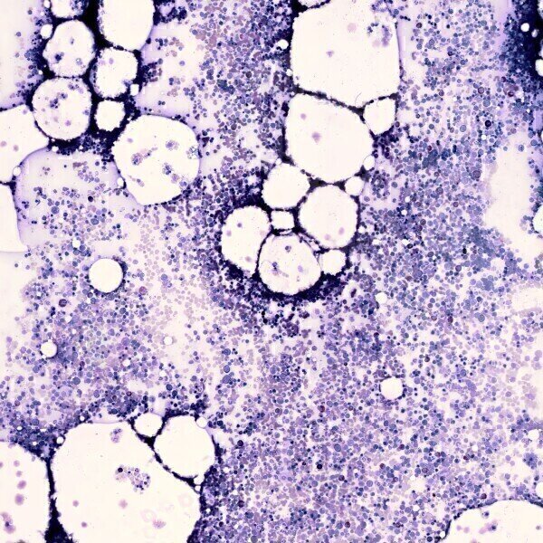 Expanded partnership launches first digital bone marrow imaging and ...