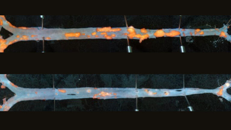 Immunotherapy reduces arterial plaque in mice, offering a potential ...
